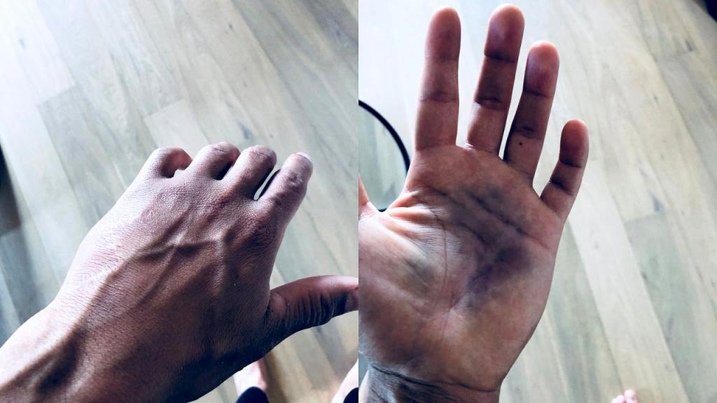 Fue campeona de la Champions... ¡con el dedo roto!